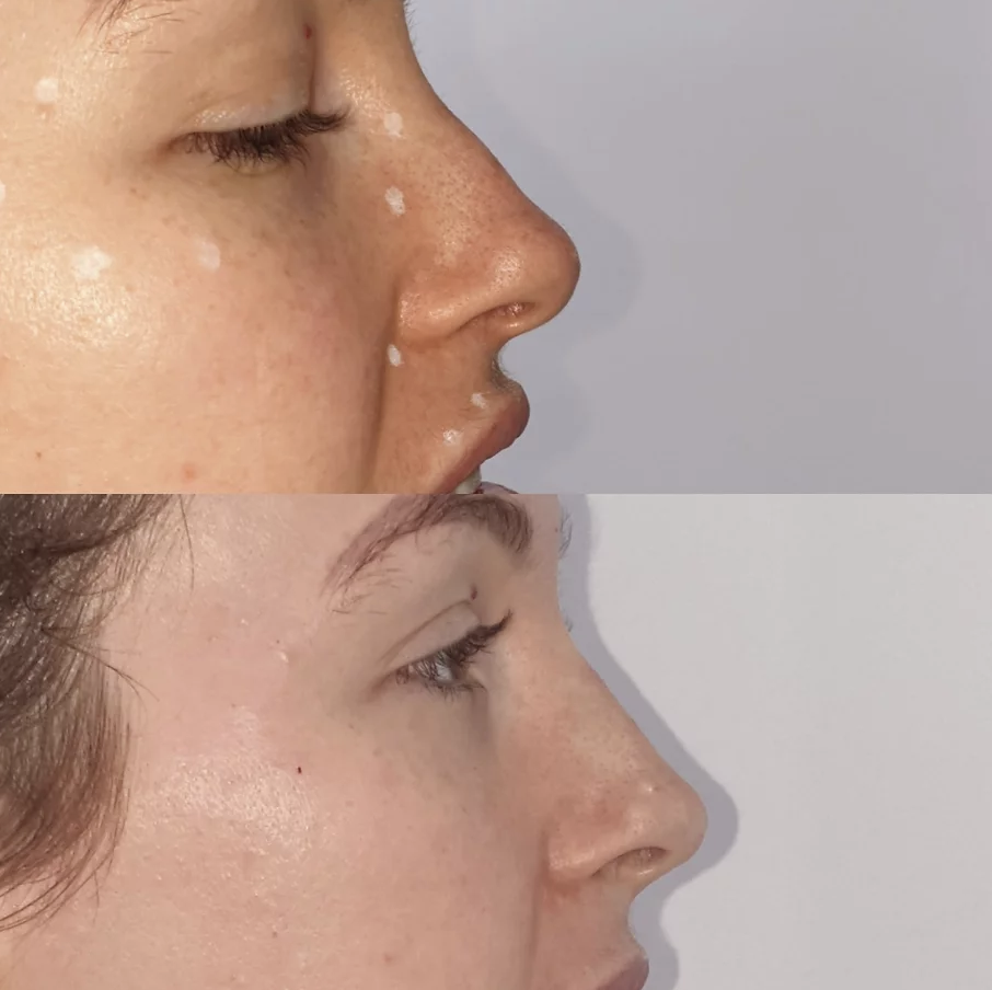 Non-Surgical Rhinoplasty | Liquid Nose Job Brisbane | Define Clinic