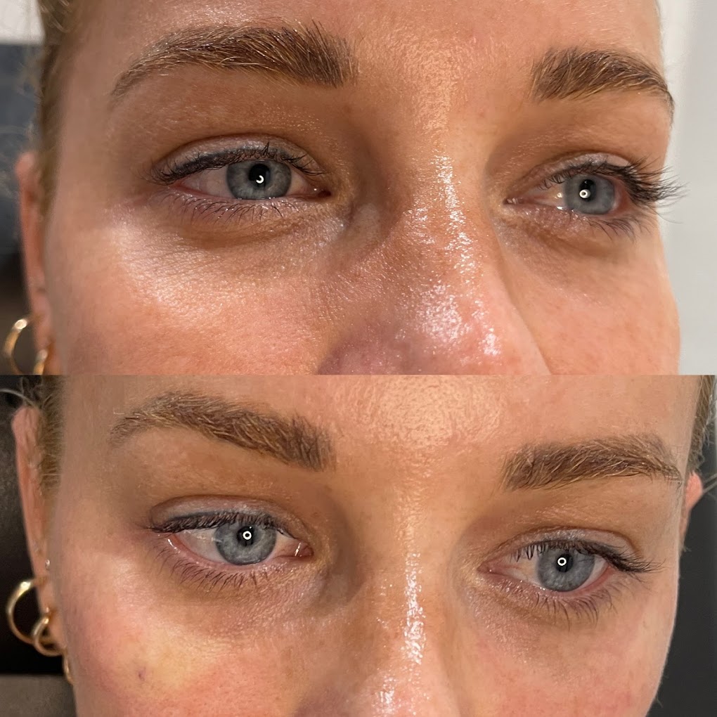 Under Eye & Tear Trough Filler Brisbane | Define Clinic