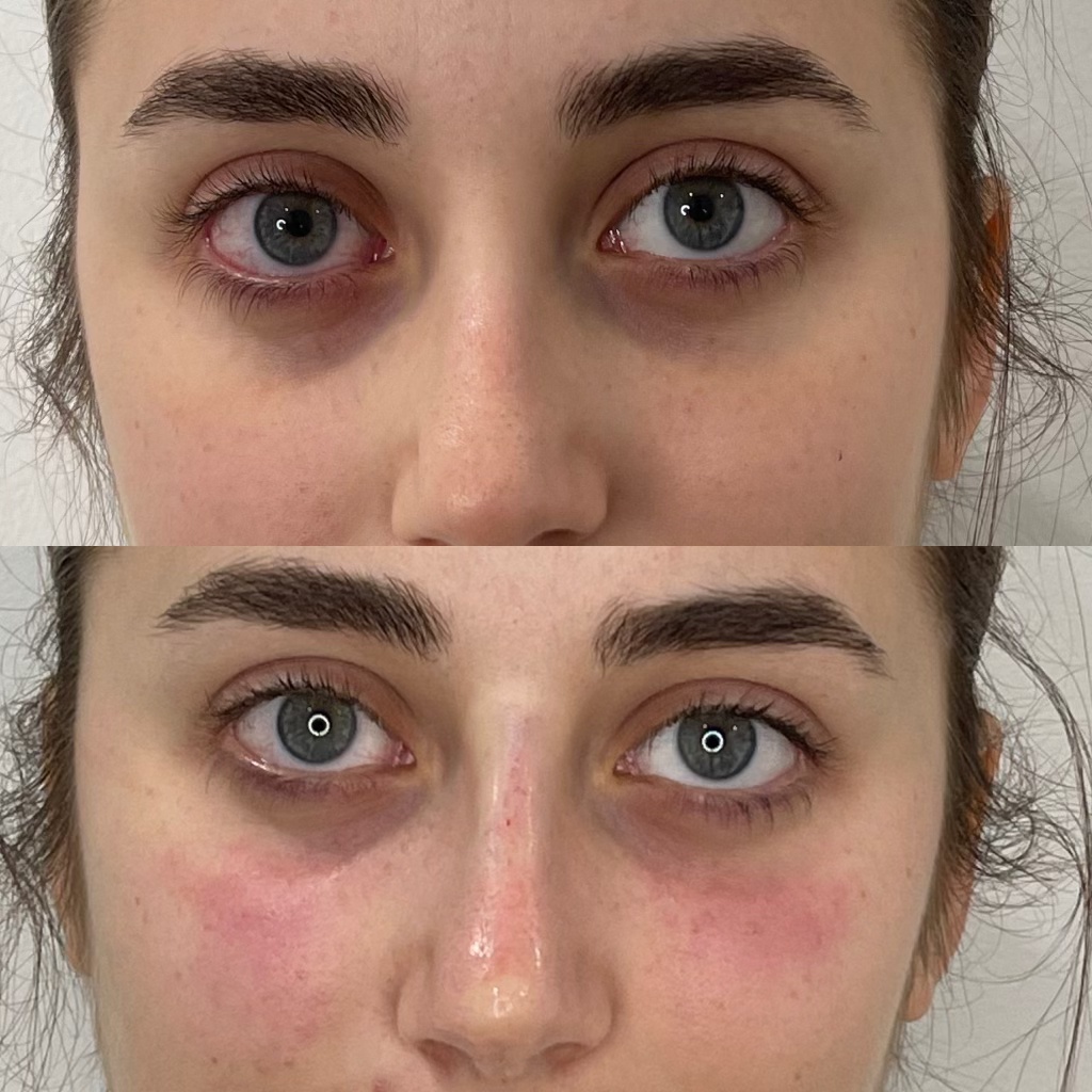 Under Eye & Tear Trough Filler Brisbane | Define Clinic